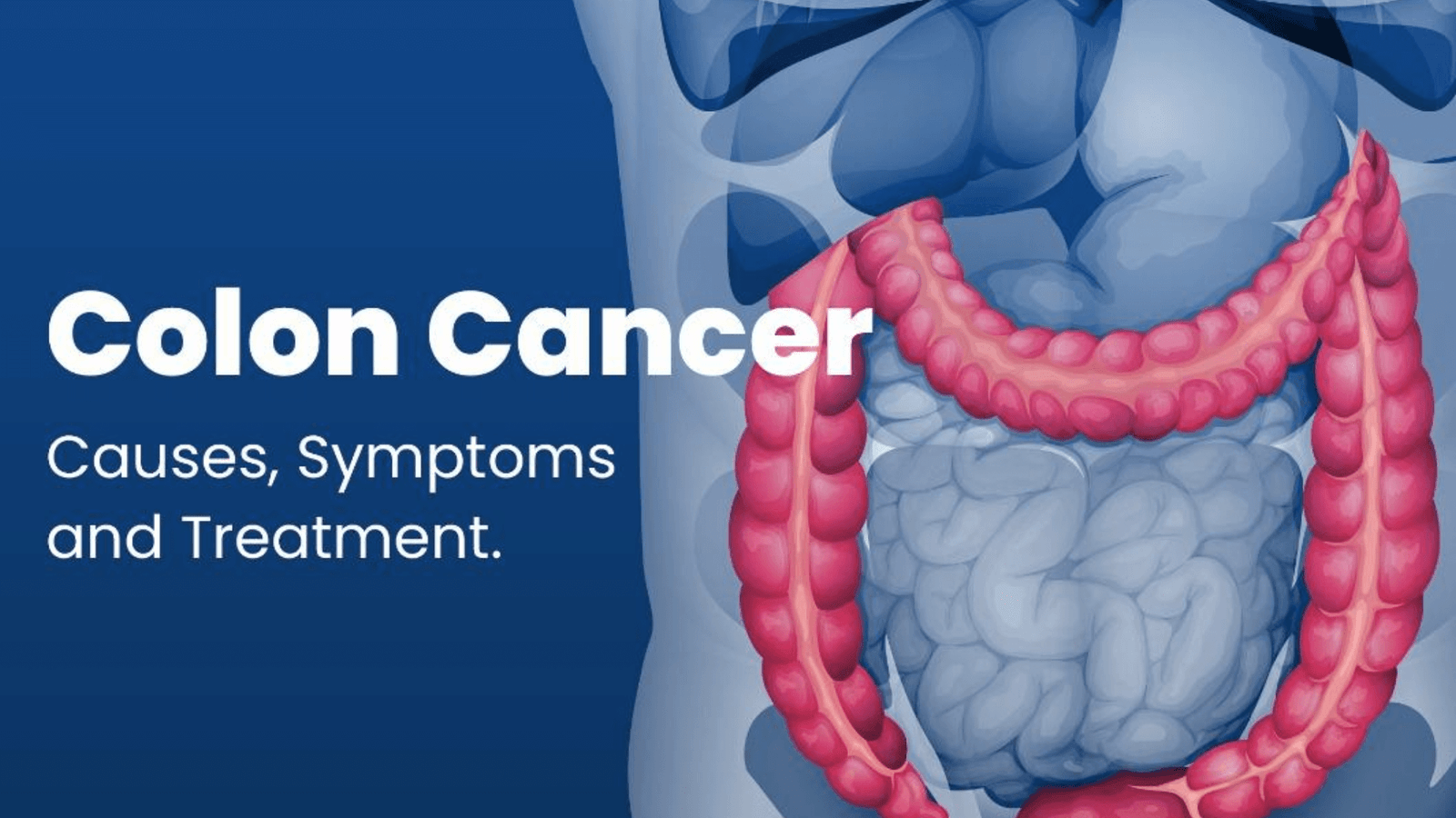 Causes Of Colon Cancer
